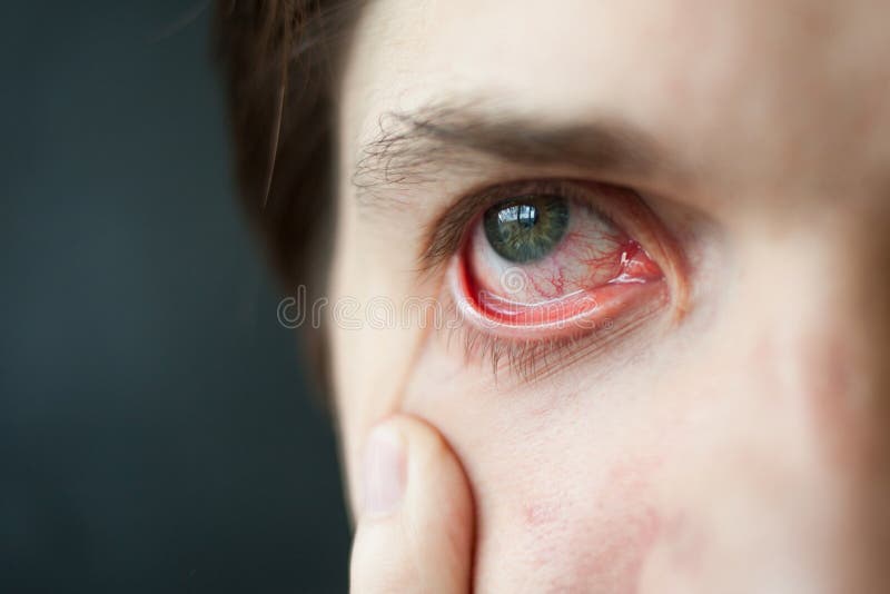 Mens Red Eye Close-up, Fatigue, Problems with Blood Vessels Stock Image ...