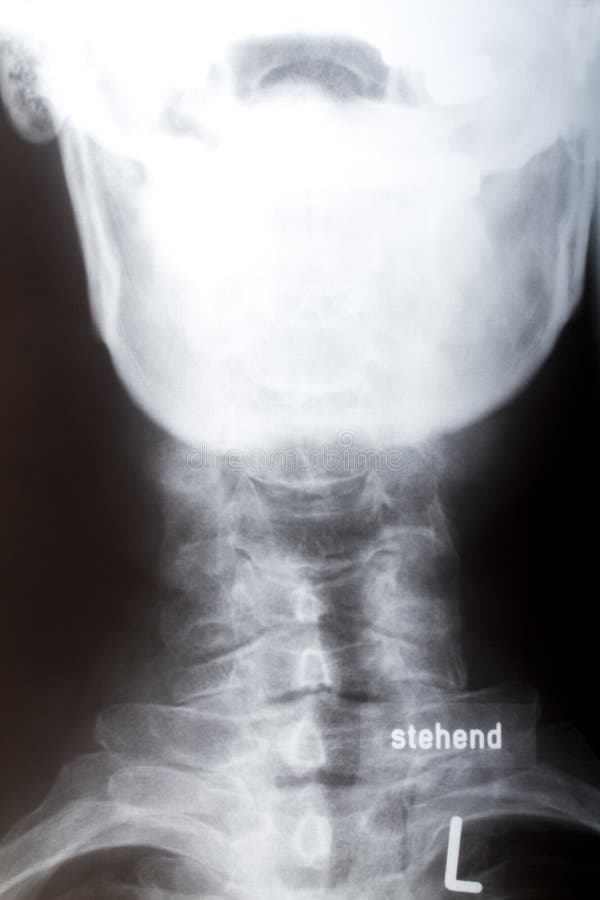 Menschliche Halsmuskelanatomie Stockbild - Bild von menschlich ...