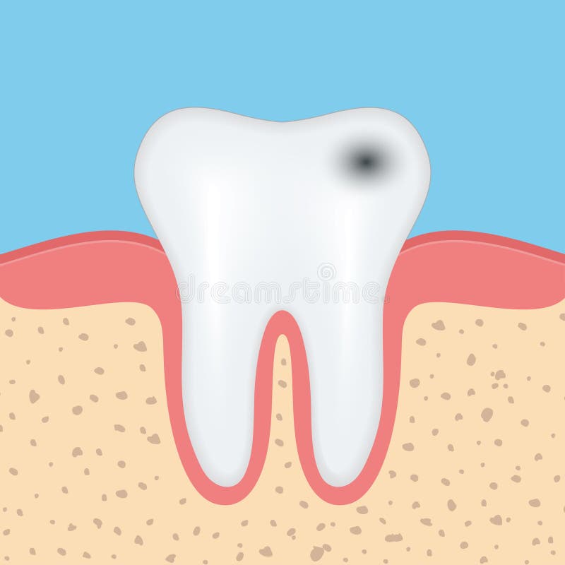 Zahn mit Karies stock abbildung. Illustration von mikrobe - 18470439