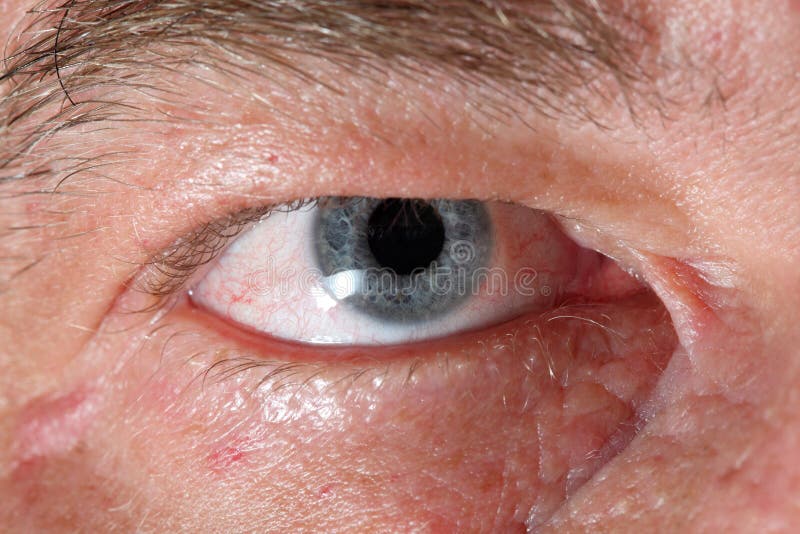 Conjunctivitis Conjunctivale Ontsteking Rode Ogen Infectie En ...