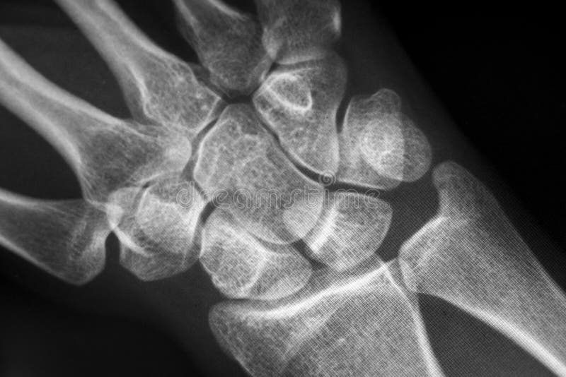 Röntgenstraal Van De Hand Toont Subluxation Van Het Proximale Falanx ...
