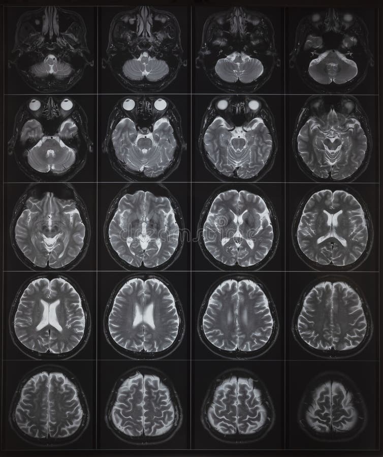 MRI Van Normale Menselijke Hersenenanatomie Stock Foto - Image of ...