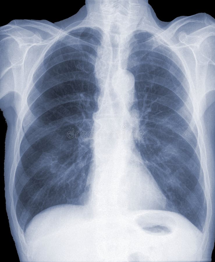 Menselijke longen stock afbeelding. Image of borst, beenderen - 13592177
