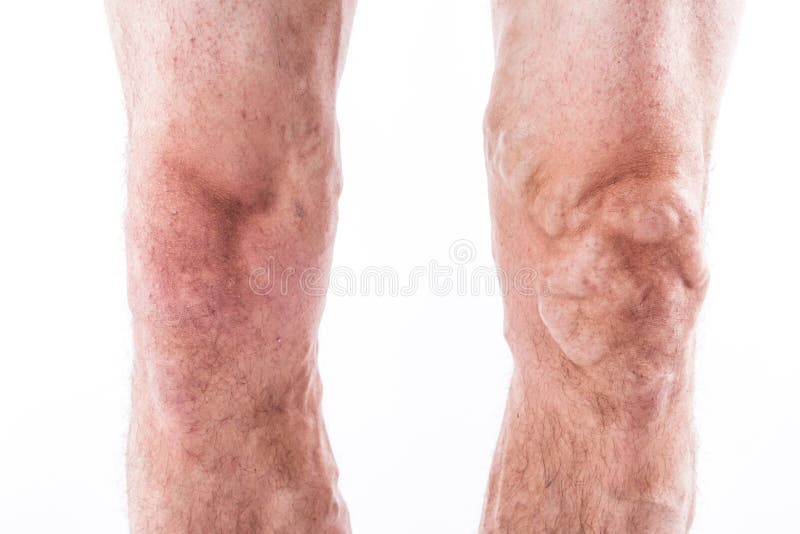 Mensen Met Spataders Van De Lagere Uitersten En Aderlijk T Stock ...