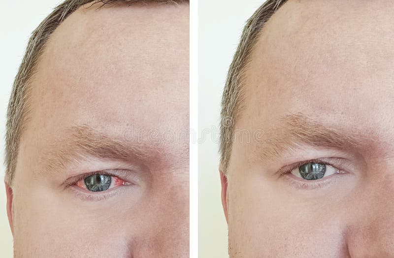 Mensen Rood Oog before and after Behandelingssymptoom Stock Afbeelding ...