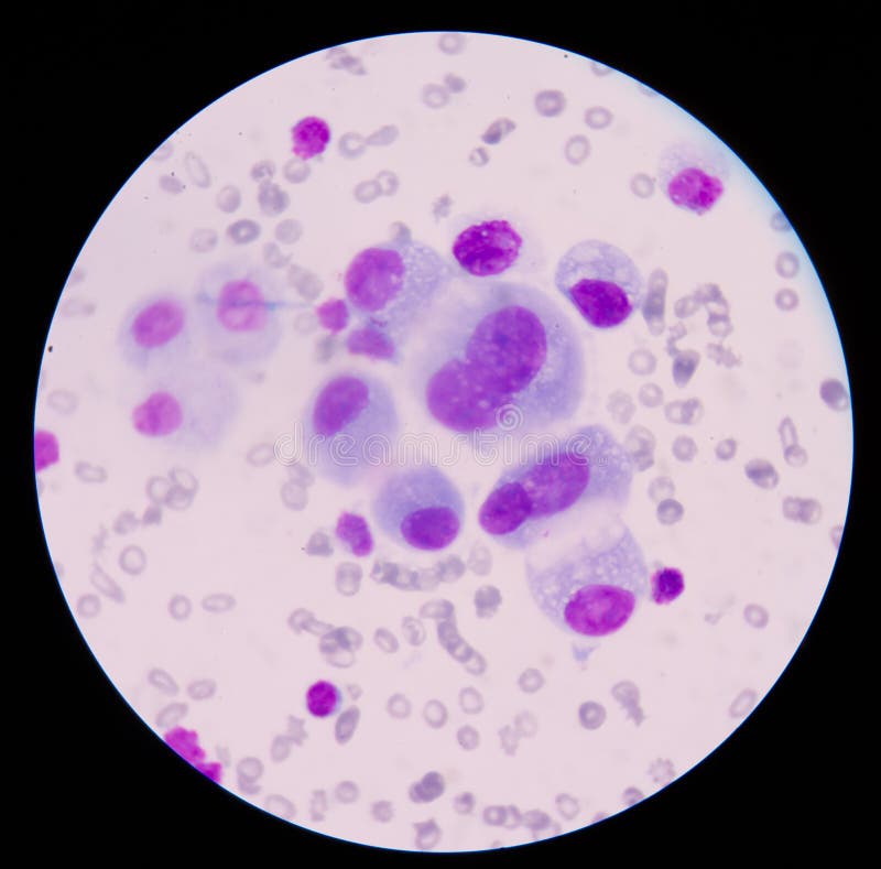 Mesothelial Cells in Body Fluid. Stock Image - Image of diagnosis ...