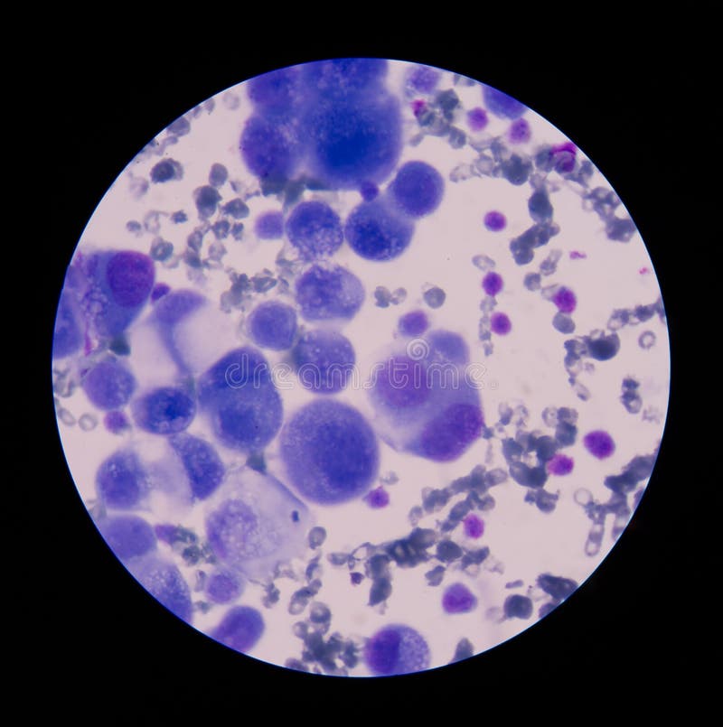 Mesothelial Cells in Body Fluid. Stock Image - Image of burn, cells ...