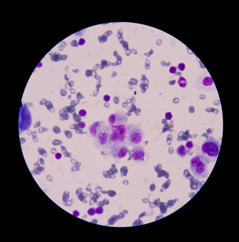 Mesothelial Cells in Body Fluid. Stock Photo - Image of clinic, cells ...
