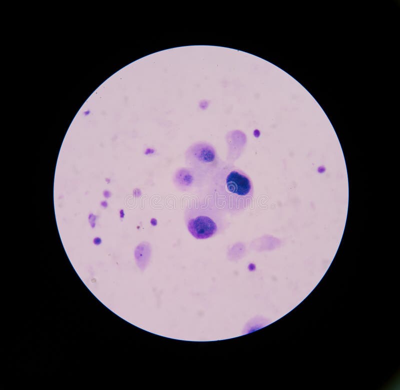 Mesothelial Malignant Cells with Multiple Nuclei Stock Image - Image of ...