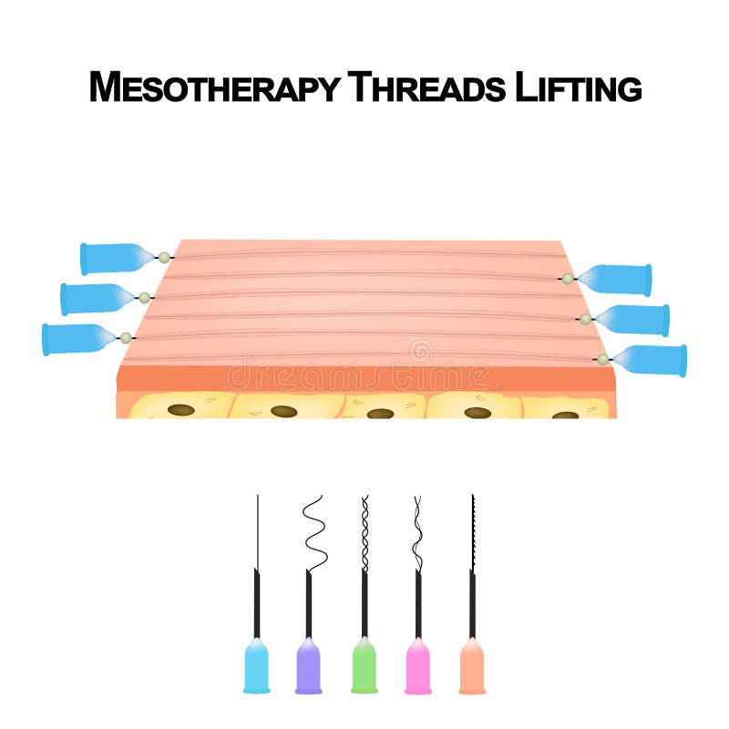 Types of Threads for Facelift. Mesotherapy Threads Lifting. the ...
