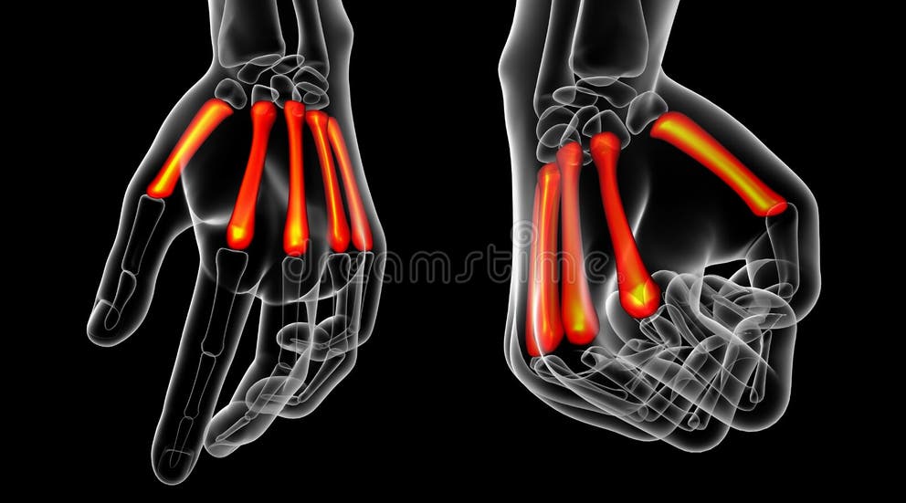 Metacarpal bone stock illustration. Illustration of phalanx - 88903826