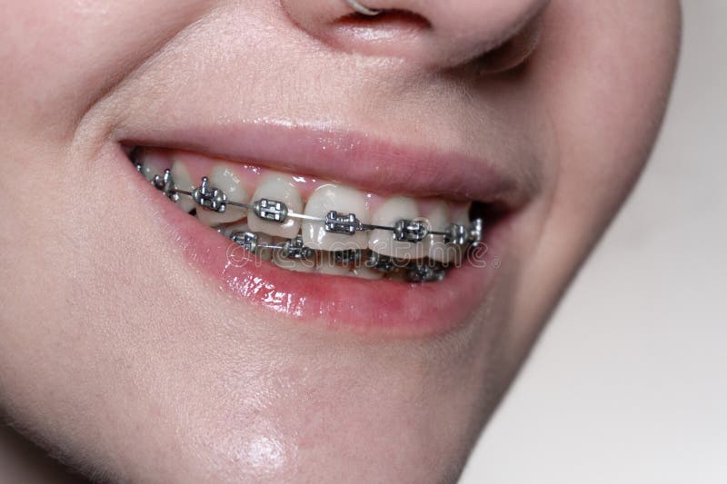Metal Braces and Bright Teeth: a Close-up Emphasizing Clean Teeth and ...