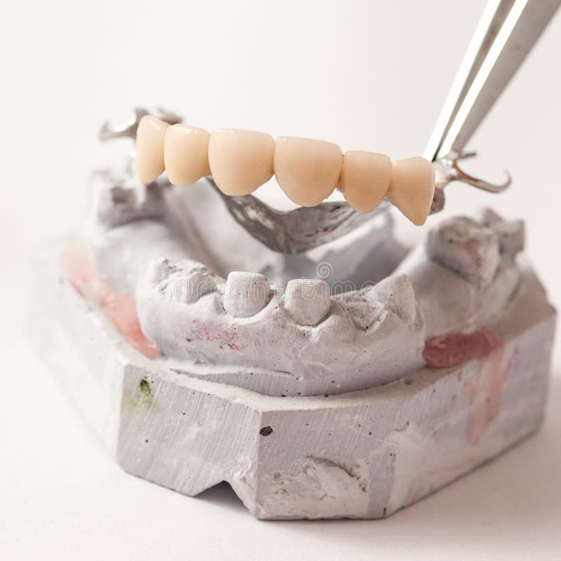Metal Ceramic Bridge Structure Stock Image - Image of prothetic, dental ...