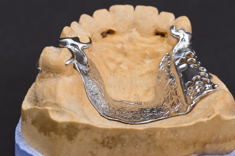 Metal Framework for a Dental Bridge Stock Image - Image of teeth ...