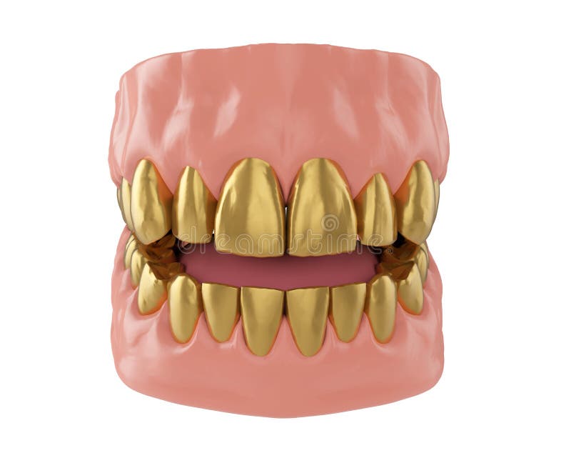 Teeth with Gold, Amalgam and Composite Inlay Dental Filling Stock ...