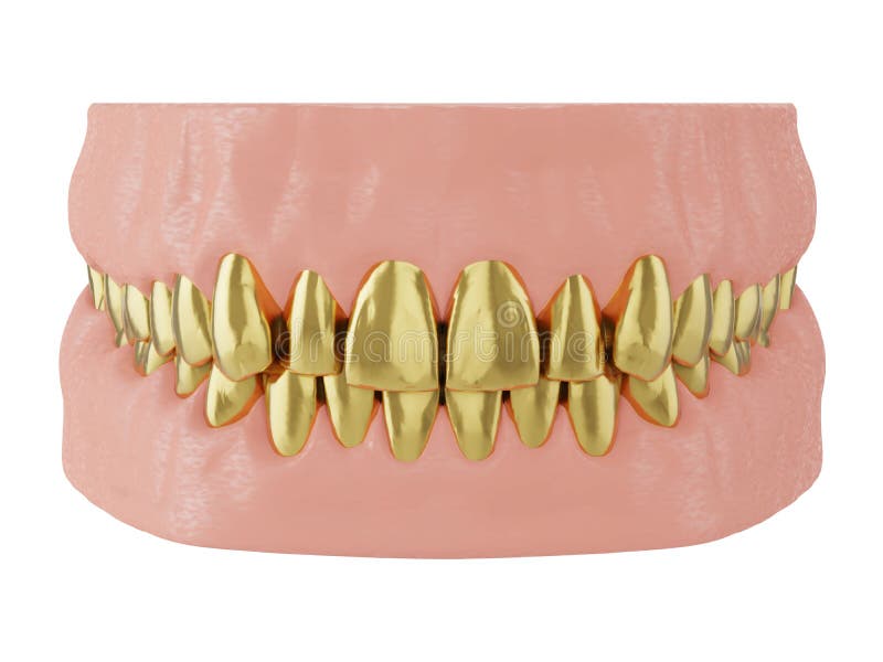 Metal Golden Teeth in the Jaw, Golden Crown of a Teeth Stock Image ...
