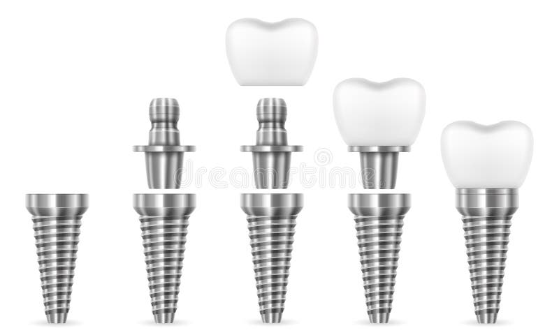 Metal Human Tooth Implant Vector Illustration Stock Vector ...