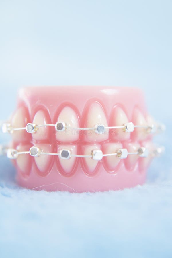 Metal Orthodontic Denture Base Stock Image - Image of braces, tooth ...