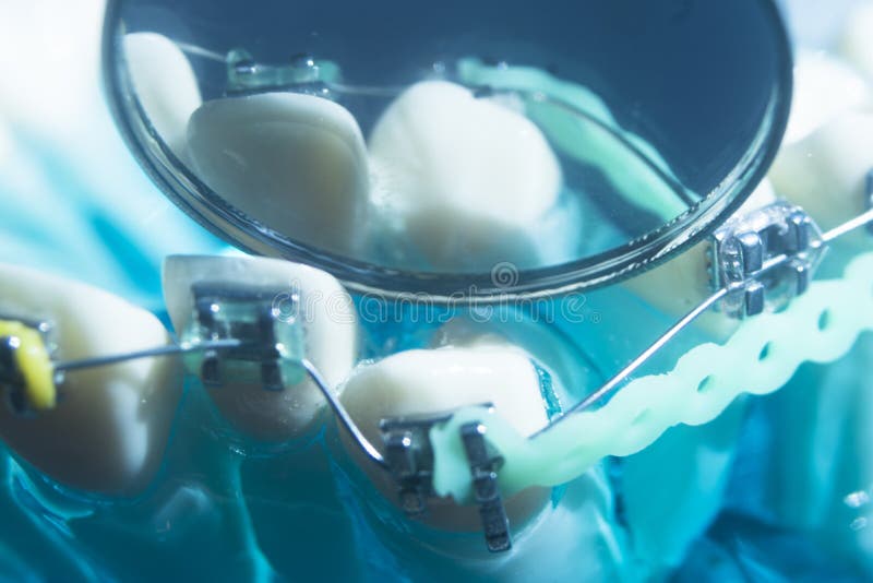 Metal teeth brackets stock image. Image of health, brace - 227923301