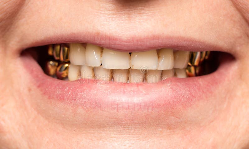 Metal teeth in the mouth stock photo. Image of brown - 93598564