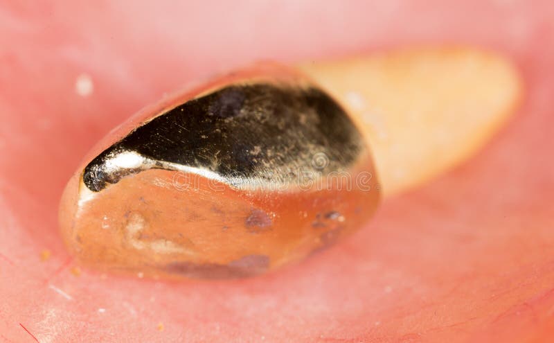 Metal tooth. macro stock image. Image of care, caries - 110543857