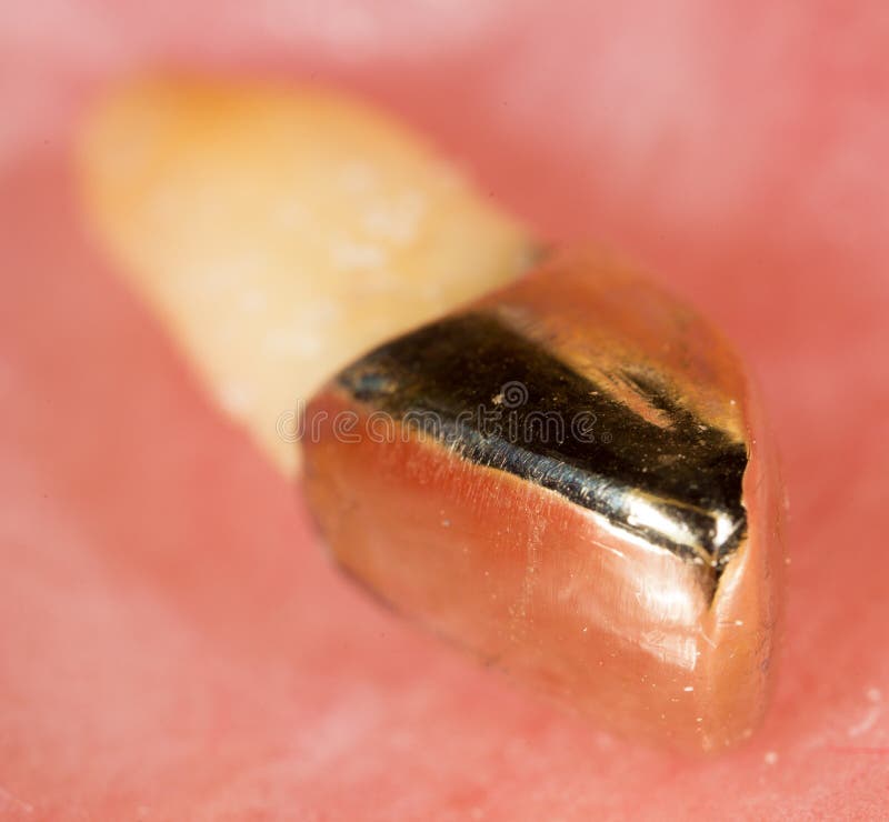 Metal tooth. macro stock image. Image of dentistry, hygiene - 89016941