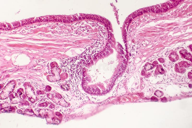 Metaplasia Squamous D'épithélium Bronchique Image stock - Image du ...
