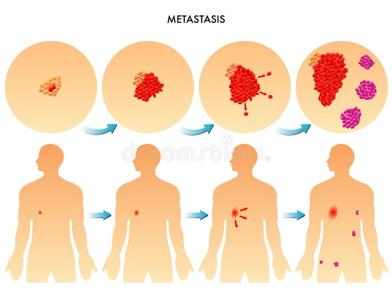 Cell Metastasis Stock Illustrations – 2,093 Cell Metastasis Stock ... Cell Metastasis Stock Illustrations – 2,093 Cell Metastasis Stock ...