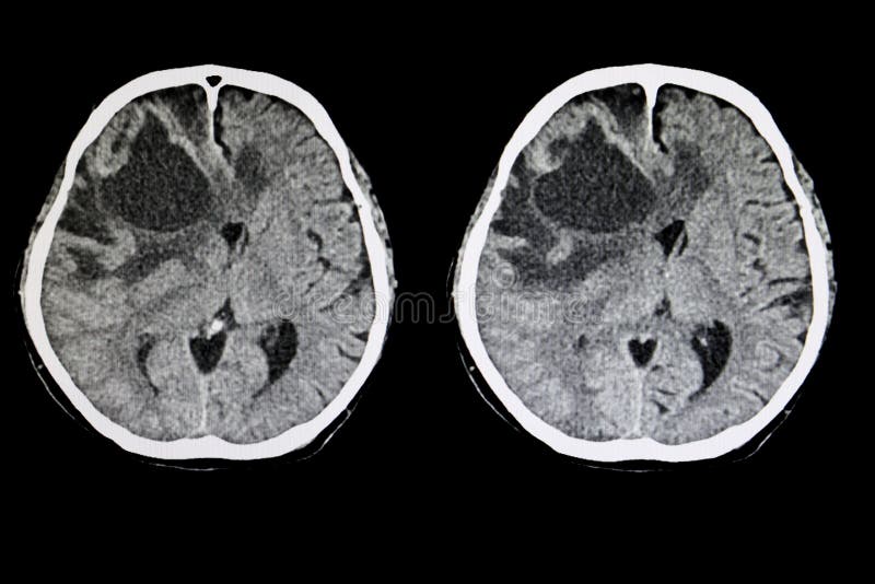 Metastatic brain tumor stock photo. Image of disease - 125005008 Metastatic brain tumor stock photo. Image of disease - 125005008