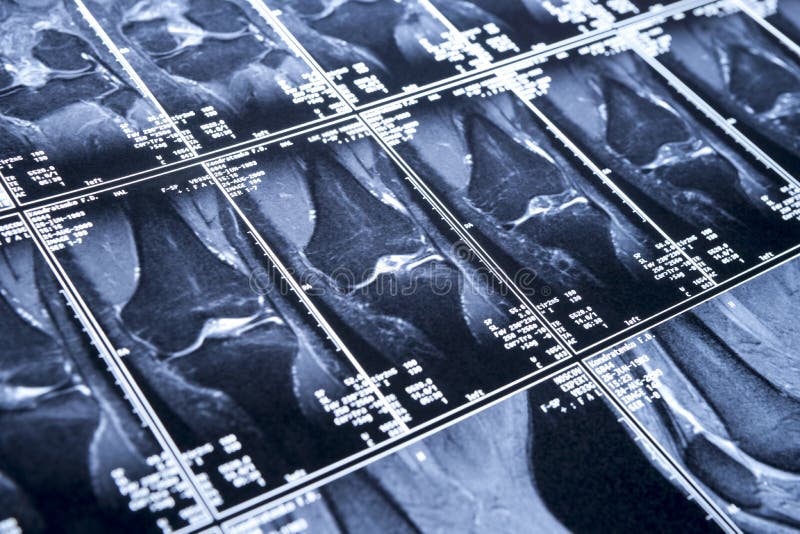 MRI De La Rodilla - Visión Superior Imagen de archivo - Imagen de ...