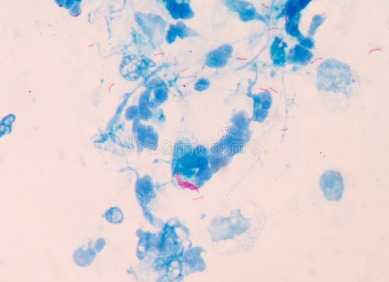 Micro Bacterium Tuberculosis. Stock Image - Image of organism, bacteria ...