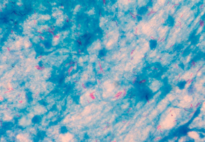 Micro Bacterium Tuberculosis. Stock Image - Image of floating, coli ...