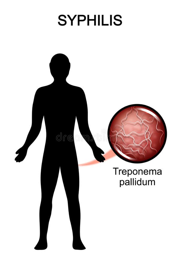 Syphilis Stock Illustrations – 917 Syphilis Stock Illustrations ...