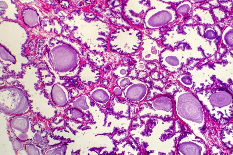 Micrograph of Prostatic Hyperplasia Stock Photo - Image of tissue ...