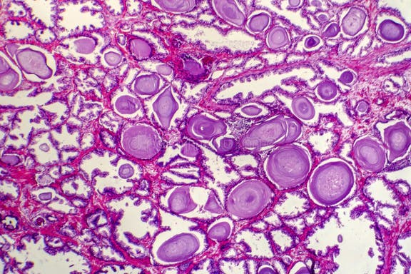 Micrograph of Prostatic Hyperplasia Stock Image - Image of microscopic ...