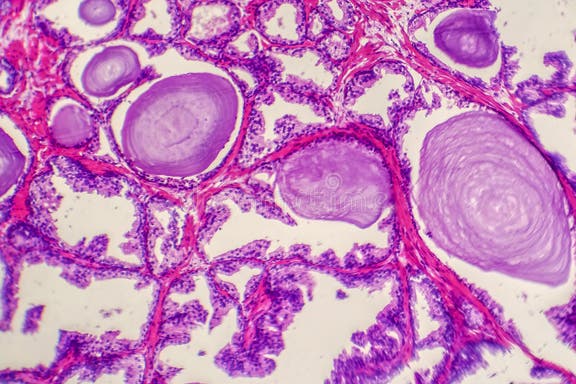 Micrograph of Prostatic Hyperplasia Stock Image - Image of examination ...