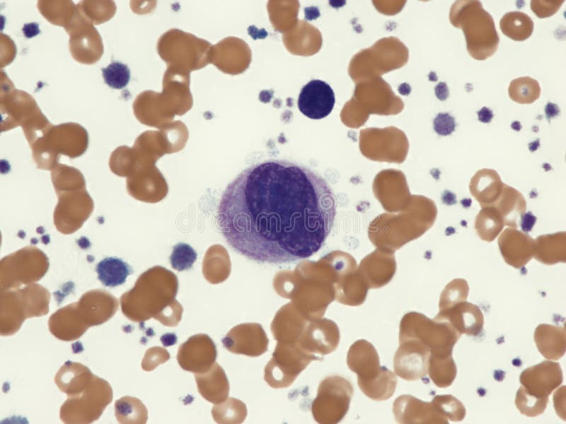 Primary Myelofibrosis Peripheral Smear