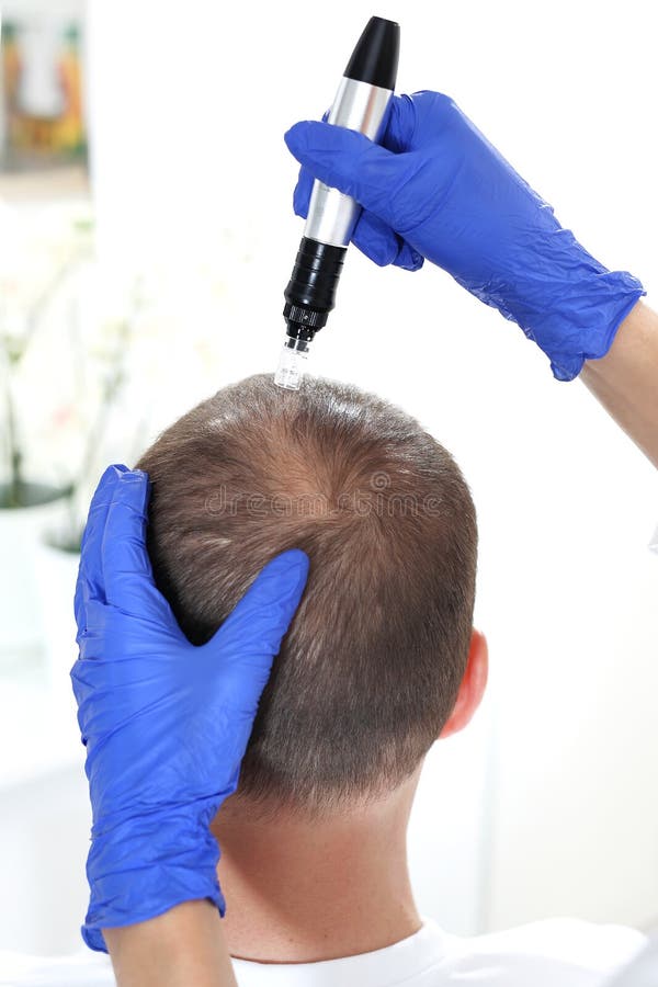 Microneedle Mesotherapy of the Scalp. Stock Photo - Image of thinning ...