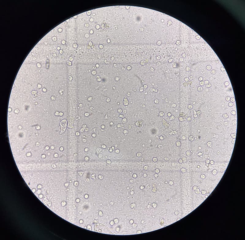 Red Blood Cell Agglutination Crossmatching Incompatible Donor Stock ...
