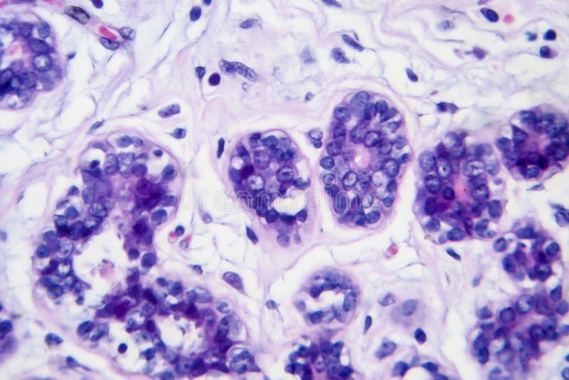 Microscopía De Luz Para Cáncer De Mama Foto de archivo - Imagen de alto ...