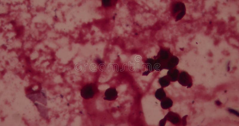 Bacteria Under a Microscope in a Hospital Stock Footage - Video of ...