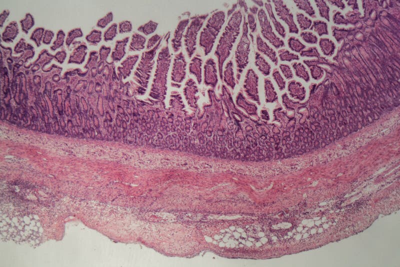 Microscope Photo of a Large Intestine Section with Inflammation Colitis ...