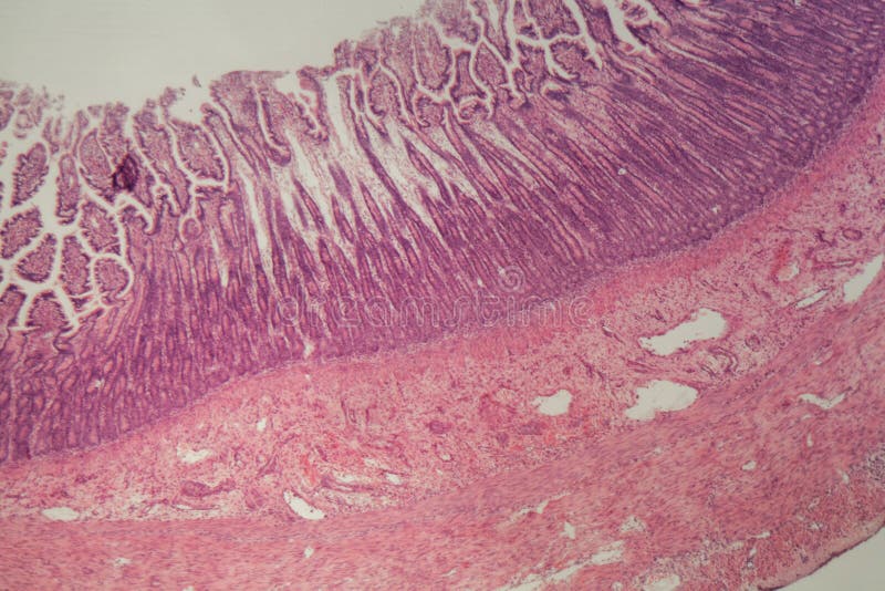 Microscope Photo of a Large Intestine Section with Inflammation Colitis ...