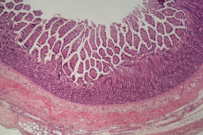 Microscope Photo of a Large Intestine Section with Inflammation Colitis ...
