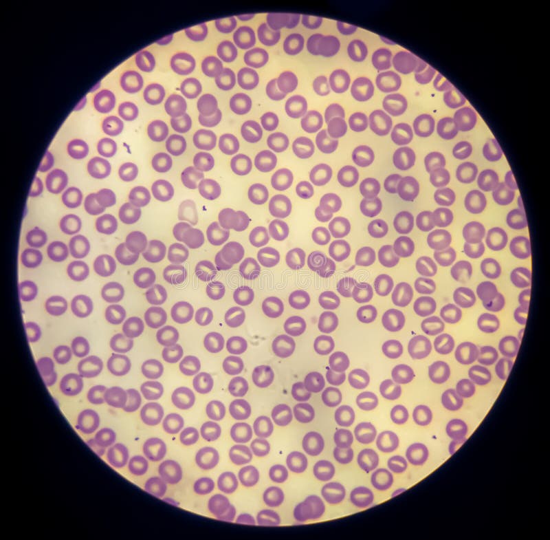 Cystinuria Diagnosis Stock Photos - Free & Royalty-Free Stock Photos ...