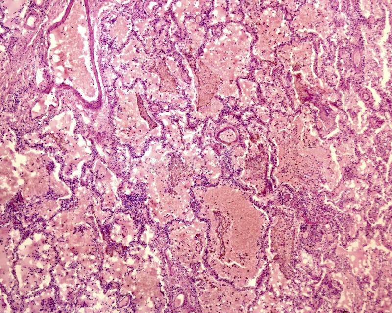 Pneumonia stock photo. Image of cell, pneumonia, alveolus - 117240718