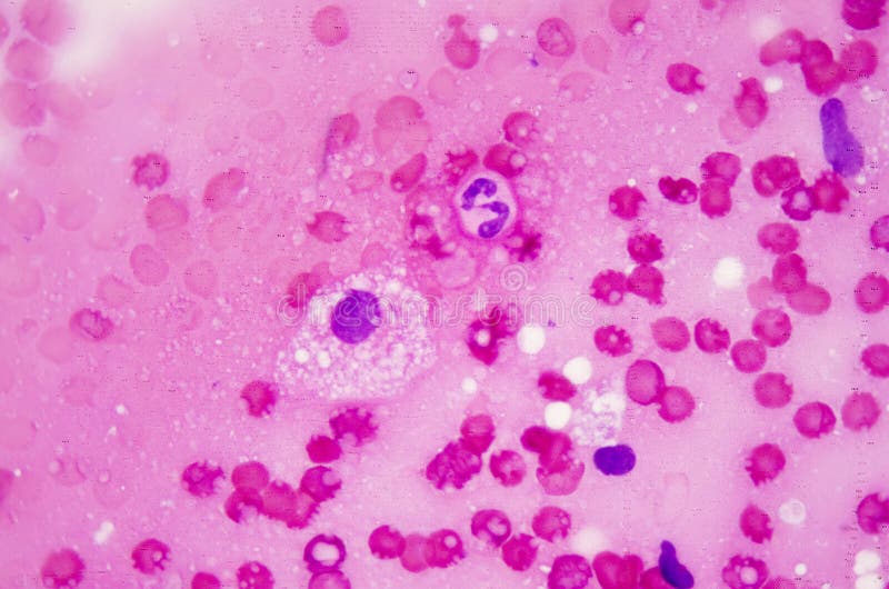 Microscopic Image of Mucinous Adenocarcinoma of the Lung. Stock Photo ...