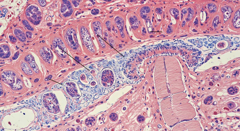 Microscopic View of Amyotrophic Lateral Sclerosis Tissue Section Stock ...