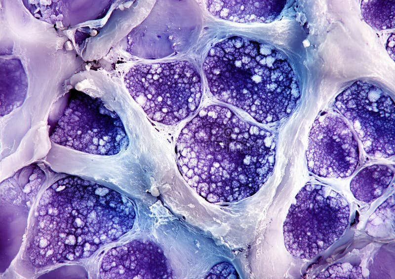 Microscopic View of Cancerous Bone Tissue Stock Illustration ...