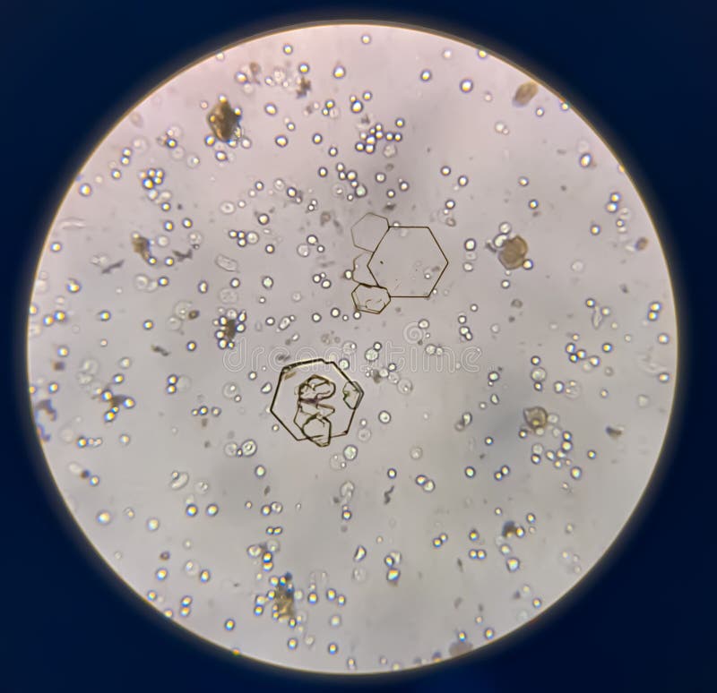 Microscopic View of Cystine Crystal Stock Photo - Image of medical ...